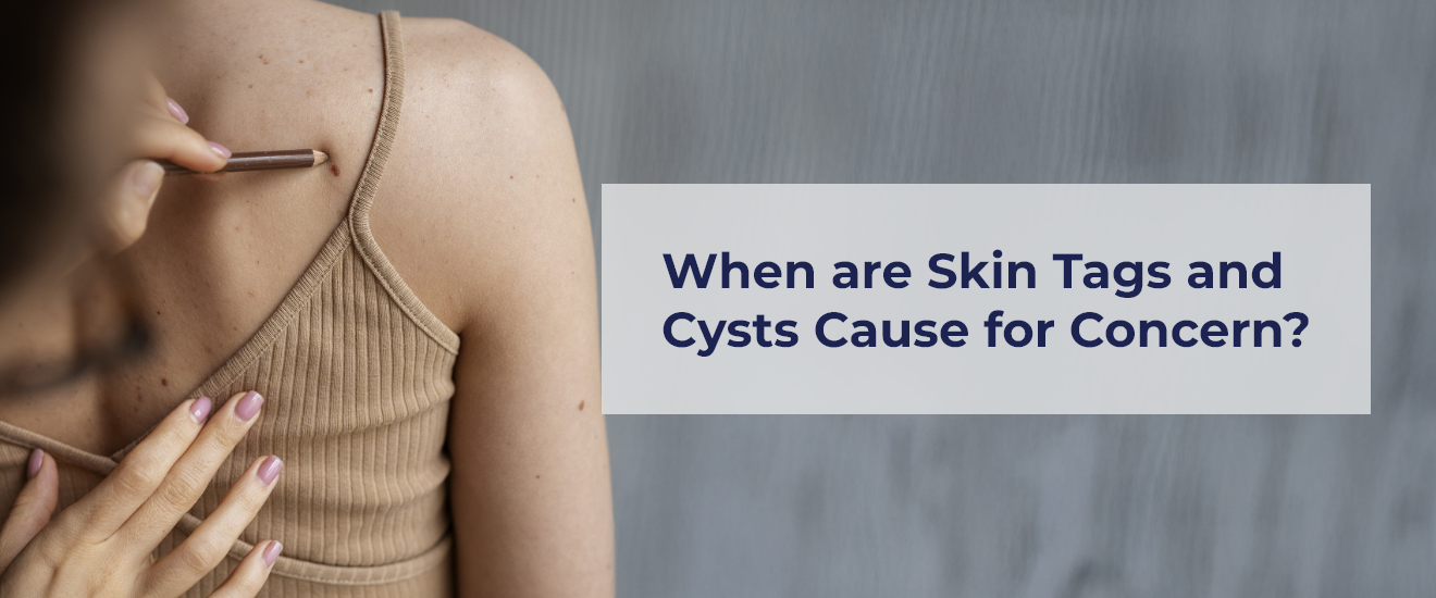 When are Skin Tags and Cysts Cause for Concern?